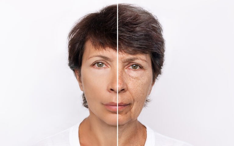 Facelift Vs Botox: Which One To Choose?